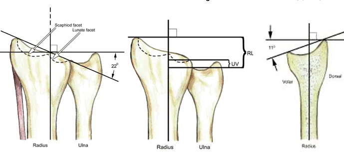 Fracturile extremității distale radiale » Centrul Medical MedLife ...